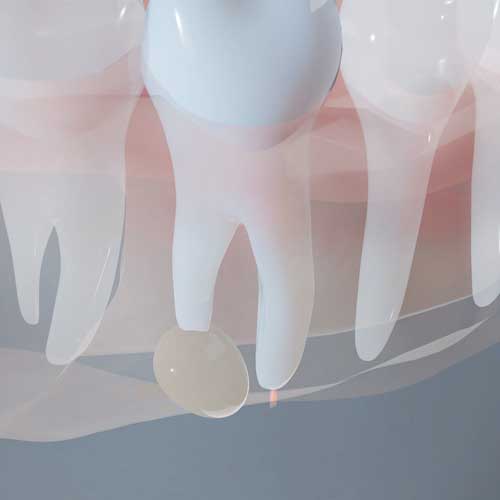 The Truth About Tooth Infections - Rockwall Dental Associates